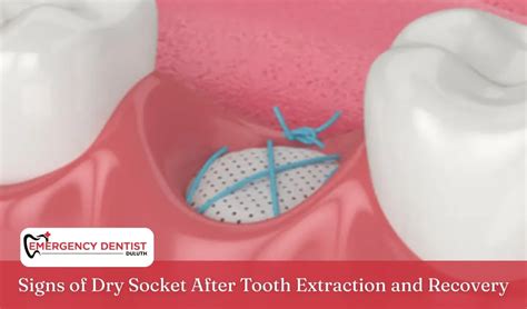 Signs Of Dry Socket After Tooth Extraction And Recovery