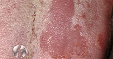 Geographic Tongue Image