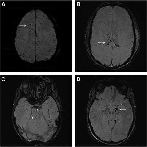 Pdf Extended Anatomical Grading In Diffuse Axonal Injury Using Mri Hemorrhagic Lesions In The
