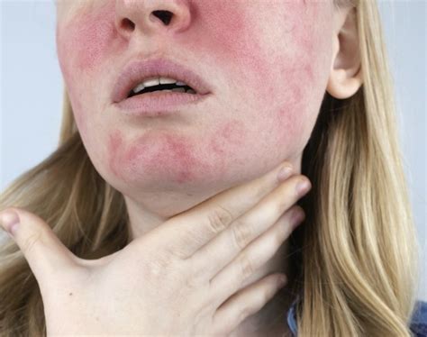 9988 프로젝트 이유없이 피곤하고 얼굴에 붉은 발진 생긴다면 루푸스 의심