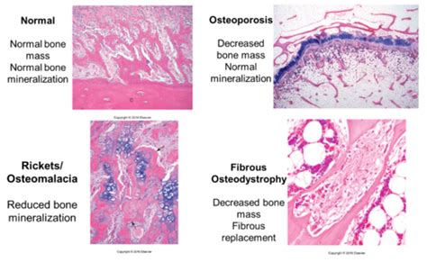 Bone Pathology Flashcards Quizlet