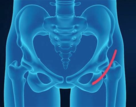 Apa Itu Operasi Total Hip Replacement Dan Berapa Biayanya Seremoniaid