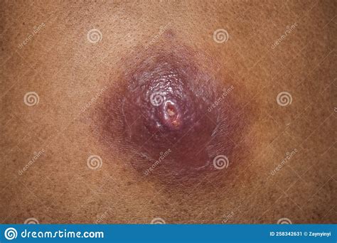 Large Carbuncle Or Abscess At The Back Of Asian Female Patient Stock Image Image Of Carbuncle