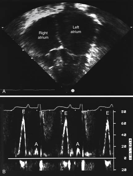 Restrictive Cardiomyopathy Thoracic Key
