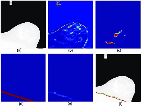 Detection Of Pectoral Boundary In A Low Contrast Mammogram Subplot