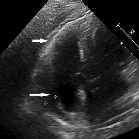A Fluid With A Fibrin Layer Behind The Right Atrium And The Right Download Scientific Diagram
