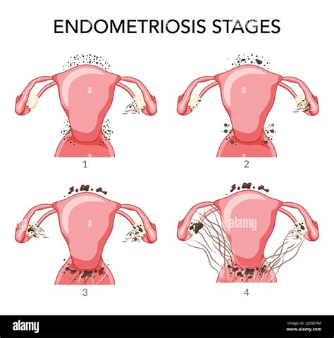 Stages Of Endometriosis Gallery Edison Health