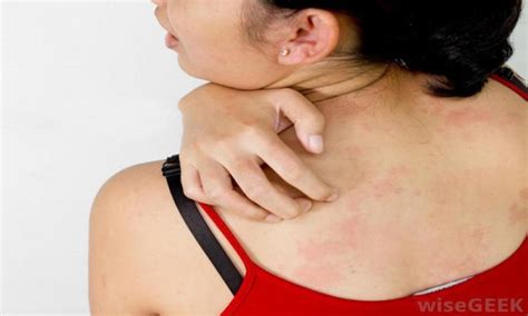 Dark Skin Patches Diabetes Healthremedy123 Easy Health And Remedy