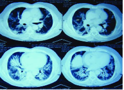Hrct Depicting Diffuse Areas Of Pulmonary Infiltration A Bilateral