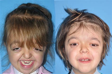 Crouzon Syndrome Cleft And Craniofacial Center Utah