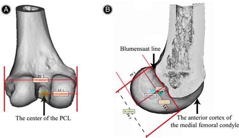 Measurement Of Anatomical Landmarks Around The Pcl Femoral Attachment Download Scientific