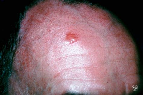 Skin Conditions That Look Like Acne—but Arent The Healthy