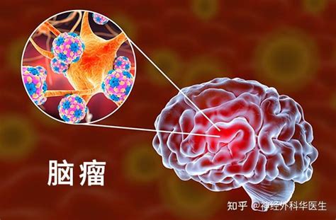 脑肿瘤真的能预防吗 知乎