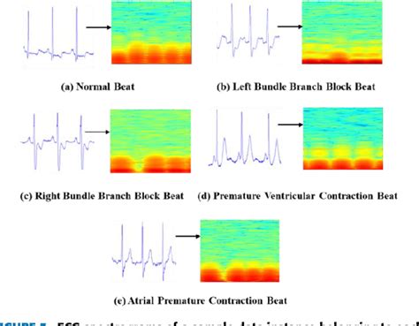 Figure 3 From Ecg Arrhythmia Classification Using Stft Based