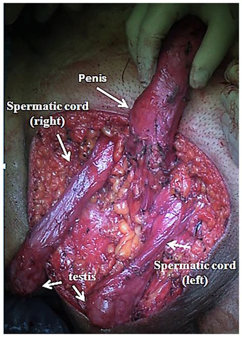 Noble Structures Following The Mass Excision Download Scientific Diagram