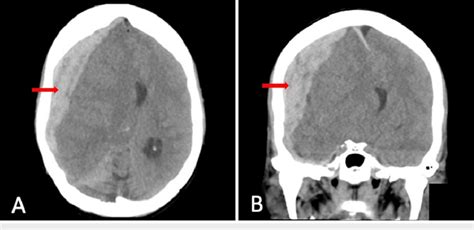 Non Contrast Ct Head Revealing A 2 Cm Right Sided Acute Sdh Indicated