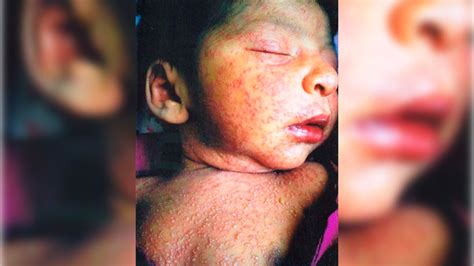 Erythema Toxicum Neonatorum