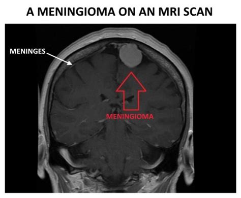 8 Most Common Symptoms Of Brain Tumor You Must Be Aware Of