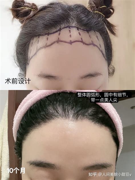 发际线种植真的香10月植发效果反馈 知乎