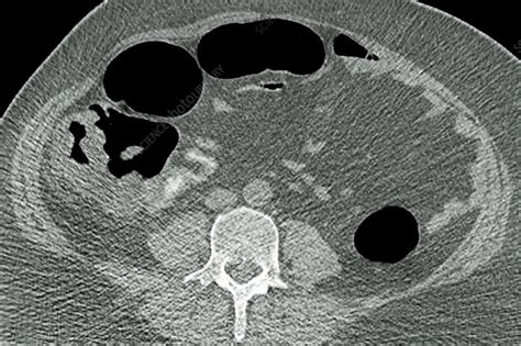 Colon Cancer Ct Scan Stock Image C0393989 Science Photo Library