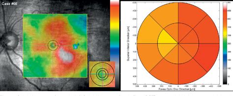 Figure 1 From Acuity In Eyes With Csme Hd Oct Shows A Weak Correlation With Visual Central