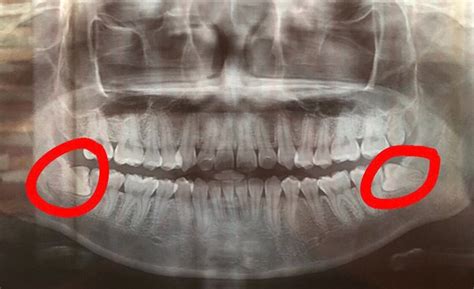 4 Rontgen Gigi Yang Ditanggung Bpjs Dentalid