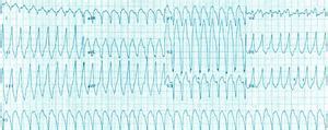 Difference Between Polymorphic And Monomorphic Ventricular Tachycardia