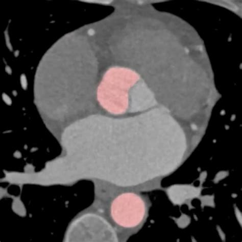 Segmentation Of The Thoracic Aorta In Contrast Enhanced Ct Images