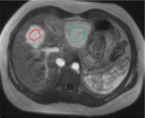 Figure 1 From Focal Nodular Hyperplasia Of The Liver Diffusion And Perfusion Mr Imaging