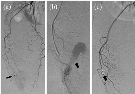 A 71 Year Old Female Patient With Massive Lower Gib A Ima