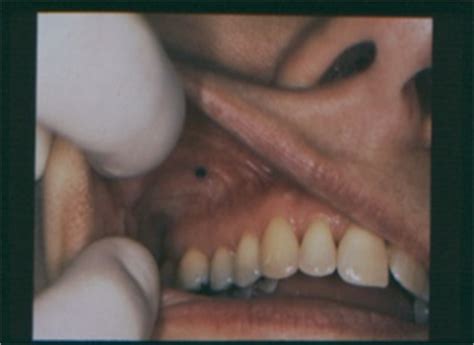 Dhyg 356 Maxillary La Injections Flashcards Quizlet