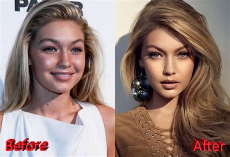 Gigi Hadid Before And After Cosmetic Surgery