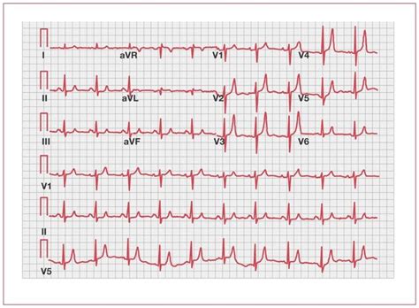 Figure 19 Hyperkalemia Nursing School Notes Ekg Cardiology Hart