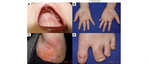 An Overview Of Disorders Associated With Goltz Syndrome Download