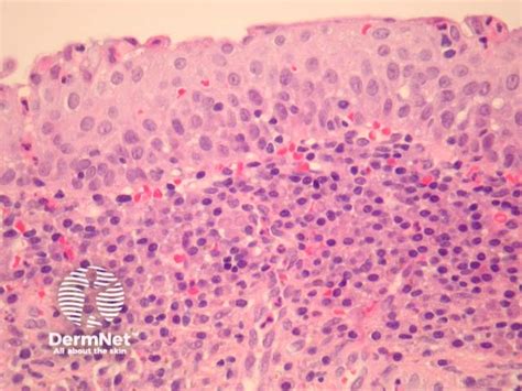 Zoon Balanitisvulvitis Plasma Cell Balanitis Vulvitis Pathology