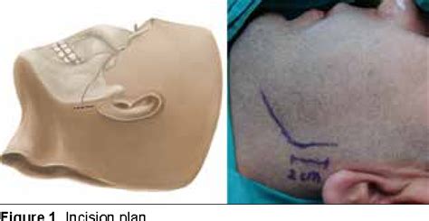 Table 1 From Retromandibular Transparotid Approach To Mandibular
