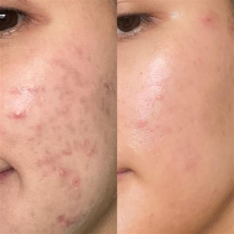 Understanding The Different Types Of Skin Moles What You Need To Know