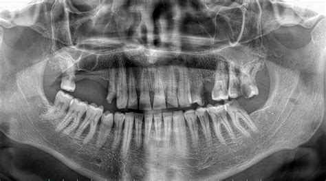 Dis Object Detection Model By Yusuf