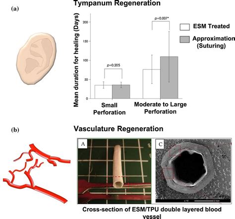A Healing Time Recorded In Patients With Different Grades Of Tympanic