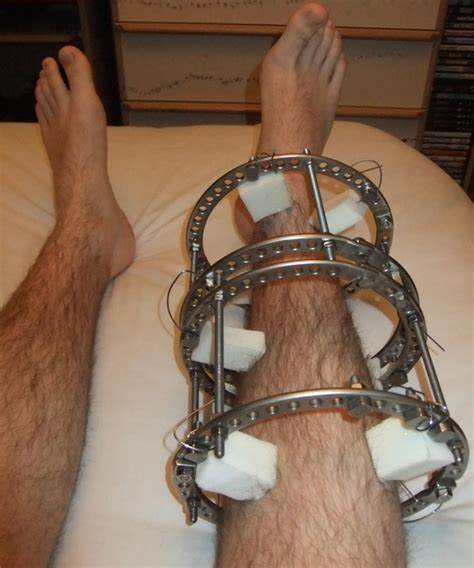 External Fixation Devices Concept And Use Bone And Spine