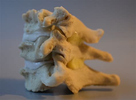 Cervical Spinal Stenosis Model Dynamic Disc Designs