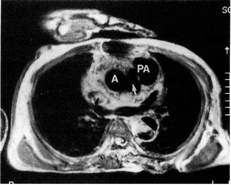 Figure 1 From Aortic Root Abscess With Fistula Formation Semantic