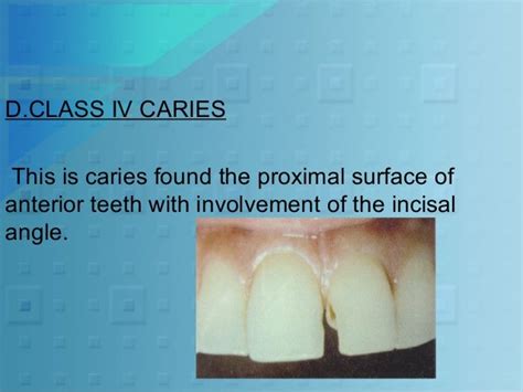 Aetiopathology And Classification Of Caries