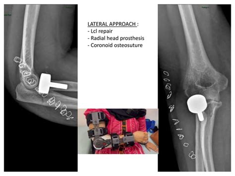 Coronoid Fracture Fix Or Not Pptx