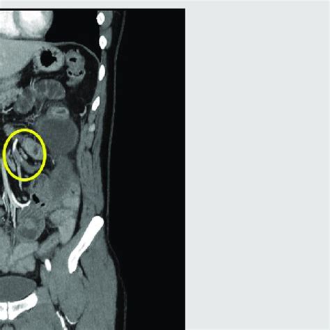 Ct Scan Showing Arterial Thrombosis And Bowel Distension Download