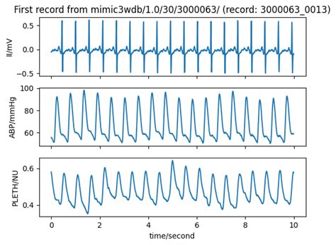 QRS Peak Detection MIMIC WFDB Tutorials