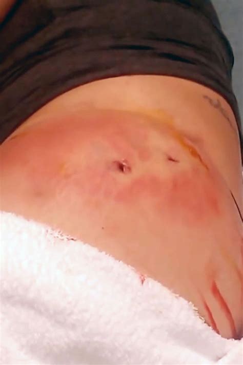 Giant Abscess