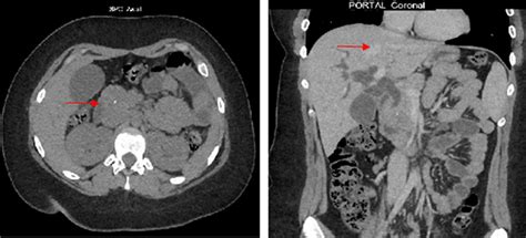 Computed Tomography Scan Showing A Cystic And Solid Mass 36 × 30 Mass