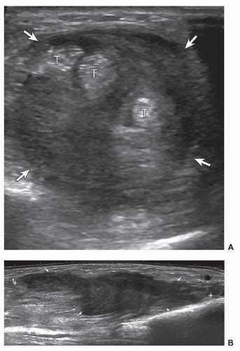 Soft Tissue Masses Radiology Key