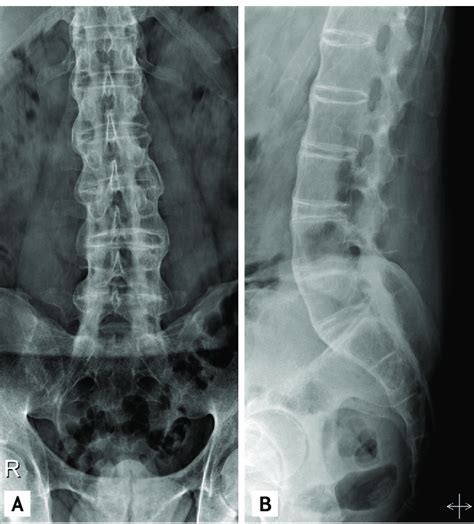 Ankylosing Spondylitis Bamboo Spine